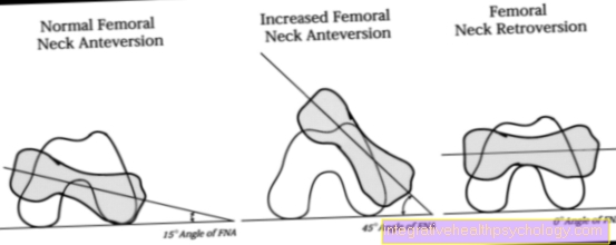 ANTEVERSIóN - ANATOMÍA-LÉXICO