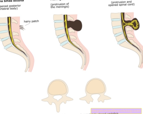 SPINA BIFIDA - PEDIATRI